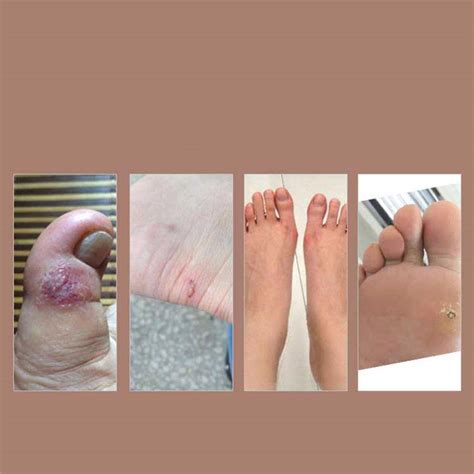 U Shaped Pads Pads Forefoot Foot Pads Foot Cushion Keep From Rubbing On ...