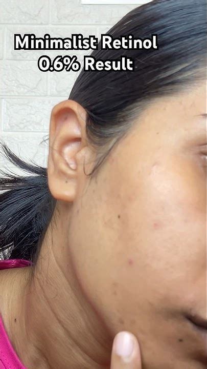 Minimalist Retinol 0.6% Result #minimalist #review #shorts - YouTube