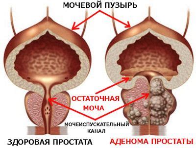 Сравнение здоровой простаты и аденомы простаты | Йога для мужчин ...