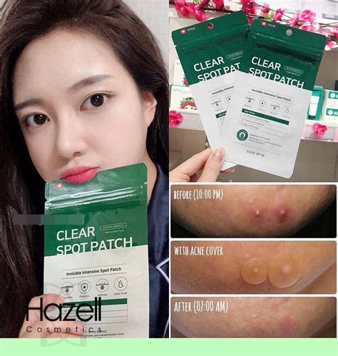 Локальные средства от прыщей - 30 Days Miracle Clear Spot Patch [Some ...
