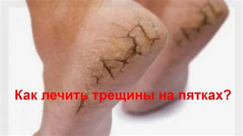 Как лечить трещины на пятках? - YouTube