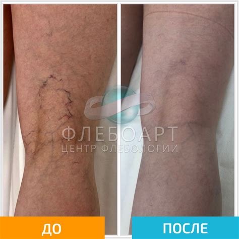 Удаление нежелательных эстетических сосудов на ногах в Краснодаре ...