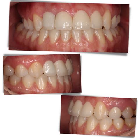 Исправление мезиального прикуса :: NORD DENTAL — сеть клиник семейной ...