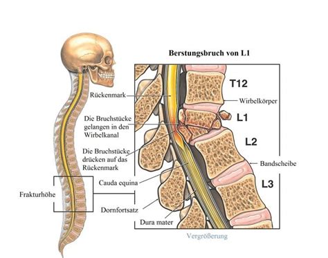 Lendenwirbelbruch, Behandlung, Operation, Alter, Therapie, Schmerzen ...