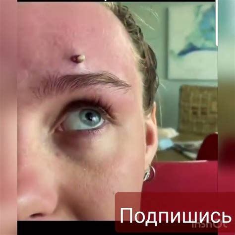 огромный прыщ на лбу который не могут выдавить огромная чёрная точка ...
