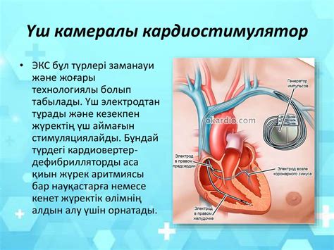 Кардиостимуляторлар - презентация онлайн