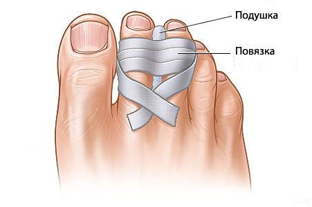 Перелом мизинца на ноге – симптомы и лечение
