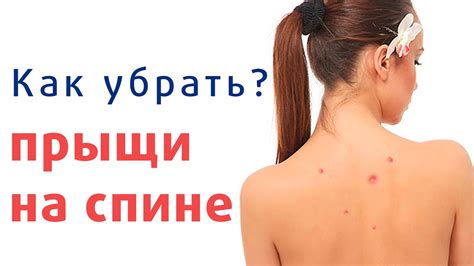 от прыщей на спине - YouTube