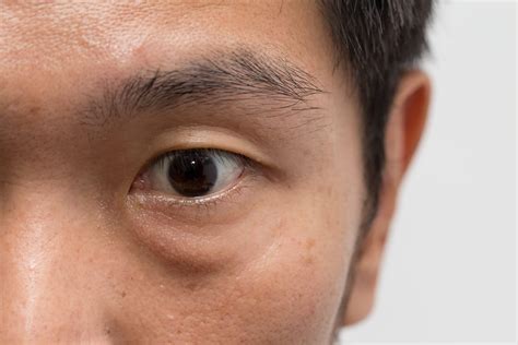 Eye Bag | HonestDocs