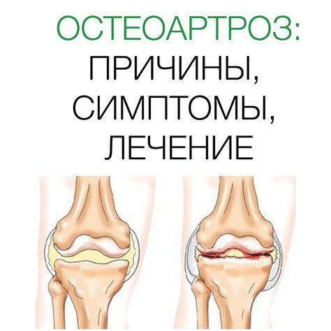 Остеоартроз: Причины, Симптомы, Лечение - Блог Врача о Здоровье