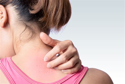 Prickly Heat: Types, Causes, Symptoms, & Treatment
