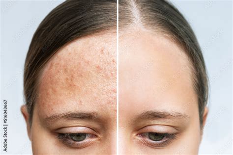 Cropped shot of a young woman's face before and after acne treatment. Pimples, allergic red rash ...