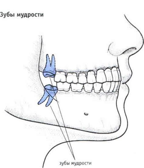 Удаление зуба мудрости, отзывы о том, больно ли удалять 8ой зуб
