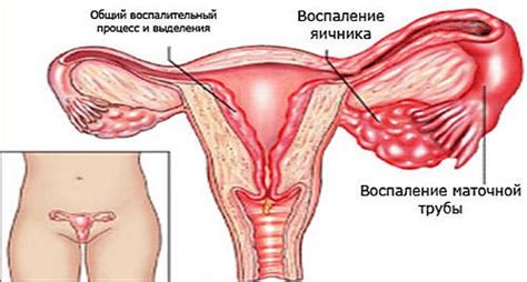 Уколы при воспалении придатков — эффективные препараты