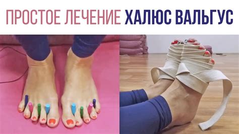 Халюс Вальгус – Лечение без операций в домашних условиях! - YouTube