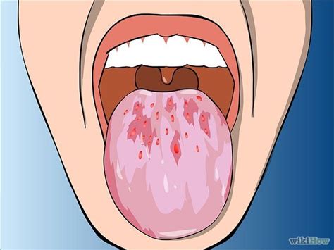Strep Throat Tongue