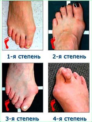 Пластырь для лечения косточек на ногах: как применять