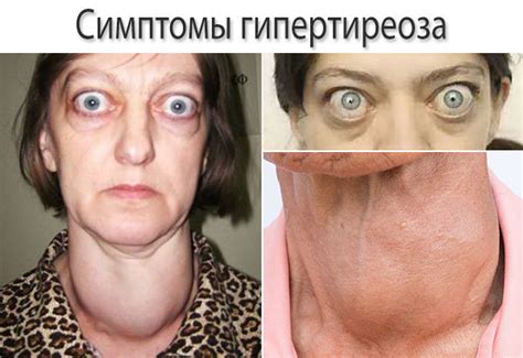 Гіпертиреоз: симптоми, лікування, причини розвитку та профілактика