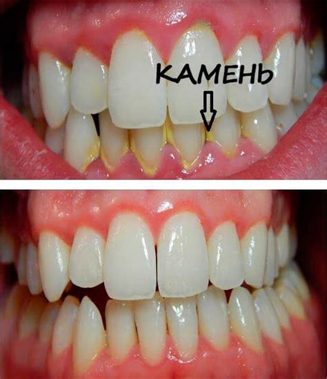 Удаление зубного камня цена в Краснодаре