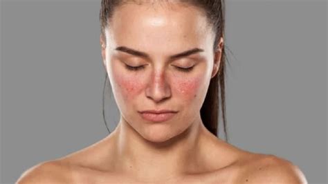 Совети за исхраната при ЛУПУС - Planet Ayurveda