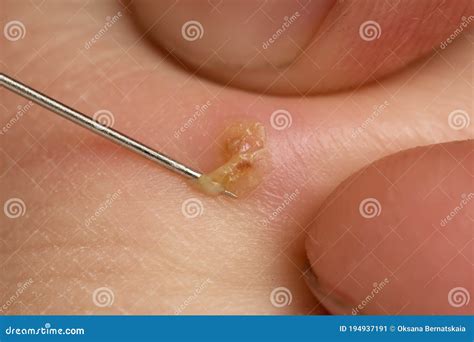 Abscess with Pus on the Skin Stock Image - Image of abscess, hygiene ...