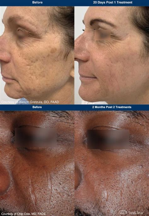 UltraClear - Swann Dermatology Partners