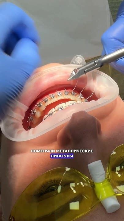 Что это за металлические лигатуры? ️🦷 Стоматология “СТОЛИЦА” 📍 Москва ...