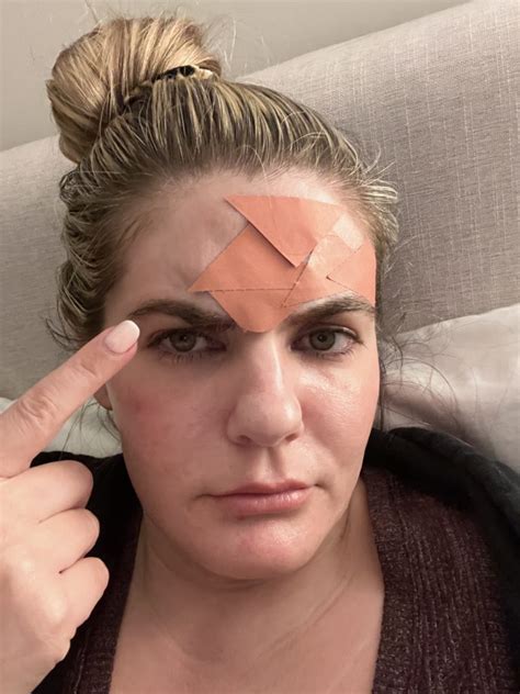 A full review of the Frownies Facial Patches | Lauren Erro