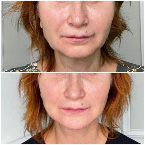 Процедуры инъекции липолитиков от 2490 руб/мл - BeautyWay Clinic 8 (499 ...