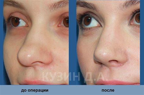 Результат операции "Ринопластика", проведенной Кузиным Д.А ...