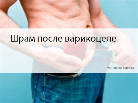 Шрам после варикоцеле / Клиника лечения варикоцеле №1