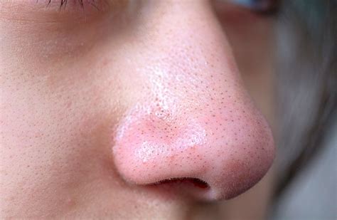 How to Get Rid of Blackheads: 11 Dermatologist-Approved Products and ...