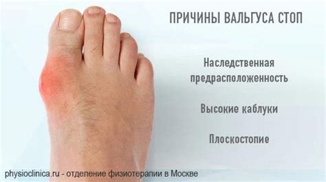 Лечение вальгуса стопы в Москве - без операции! Цена от 2600 руб за ...