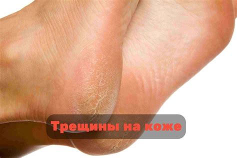 Трещины на коже причины, симптомы и лечение трещин на коже