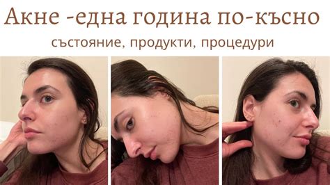 АКНЕ - една година по-късно - СЪСТОЯНИЕ, НОВИ ПРОДУКТИ, ПРОЦЕДУРИ - YouTube