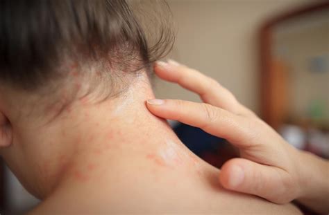 Top 10 Home Remedies for Prickly Heat - JKYog Naturopathy Hospital