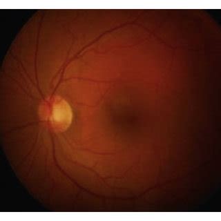 Retinal image samples from e-Ophtha ((a) affected and (b) healthy) and ...