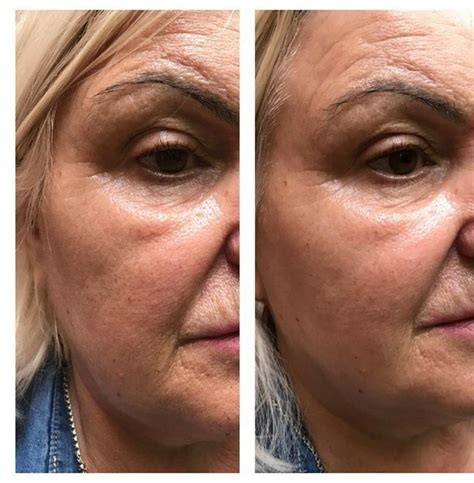 пептидный пилинг с ботокс эффектом dermaquest power peptide resurfacer ...