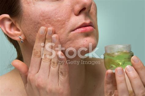 Acne Therapy Stock Photo | Royalty-Free | FreeImages