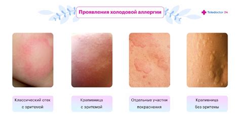 Аллергия на холод — признаки, симптомы, обострение, лечение холодовой ...