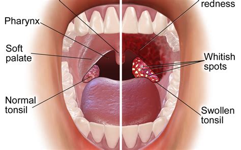 Healthy Tonsils Matter: The Hidden Heroes of Your Immune Health - Super ...