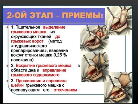 Паховая грыжа - презентация онлайн