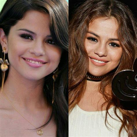 Top 92+ Pictures Selena Gomez Plastic Surgery Before And After Photos Sharp