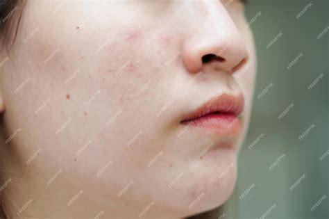 Premium Photo | Acne pimple and scar on skin face disorders of sebaceous glands teenage girl ...