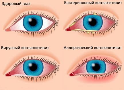 Красные глаза: причины и лечение, глазные капли от покраснения и ...
