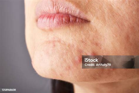 Skin Problem With Acne Diseases Close Up Woman Face With Whitehead Pimples On Chin Menstruation ...