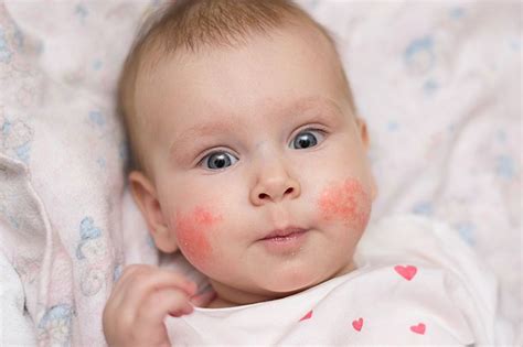 Аллергия на лице грудничка