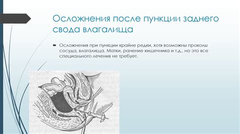 Пункция заднего свода влагалища (кульдоцентез) - презентация онлайн