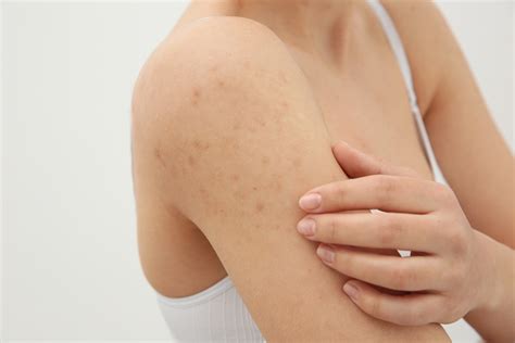 Чесотка. Лечение чесотки в домашних условиях — Balabolkina.Ru
