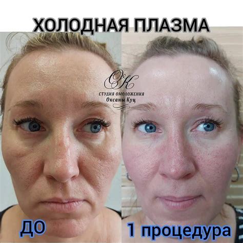 ᐉ холодная плазма в косметологии и медицине. что это такое, фото ...